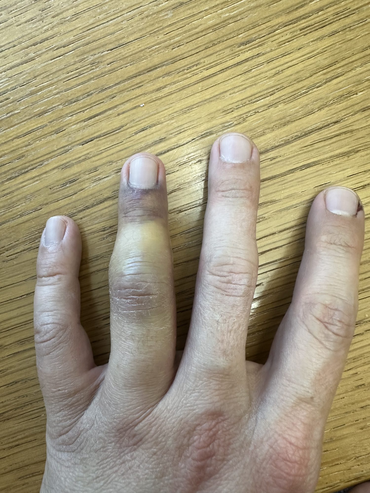 Battle Scars: Dealing with Disability in the Hobby | Goonhammer